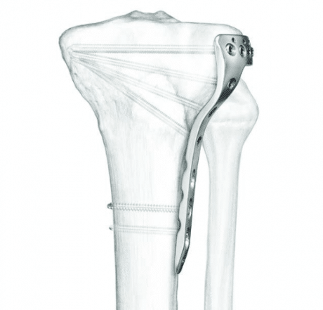 Choosing the Right Bone Plate - Buying Guides MedicalExpo